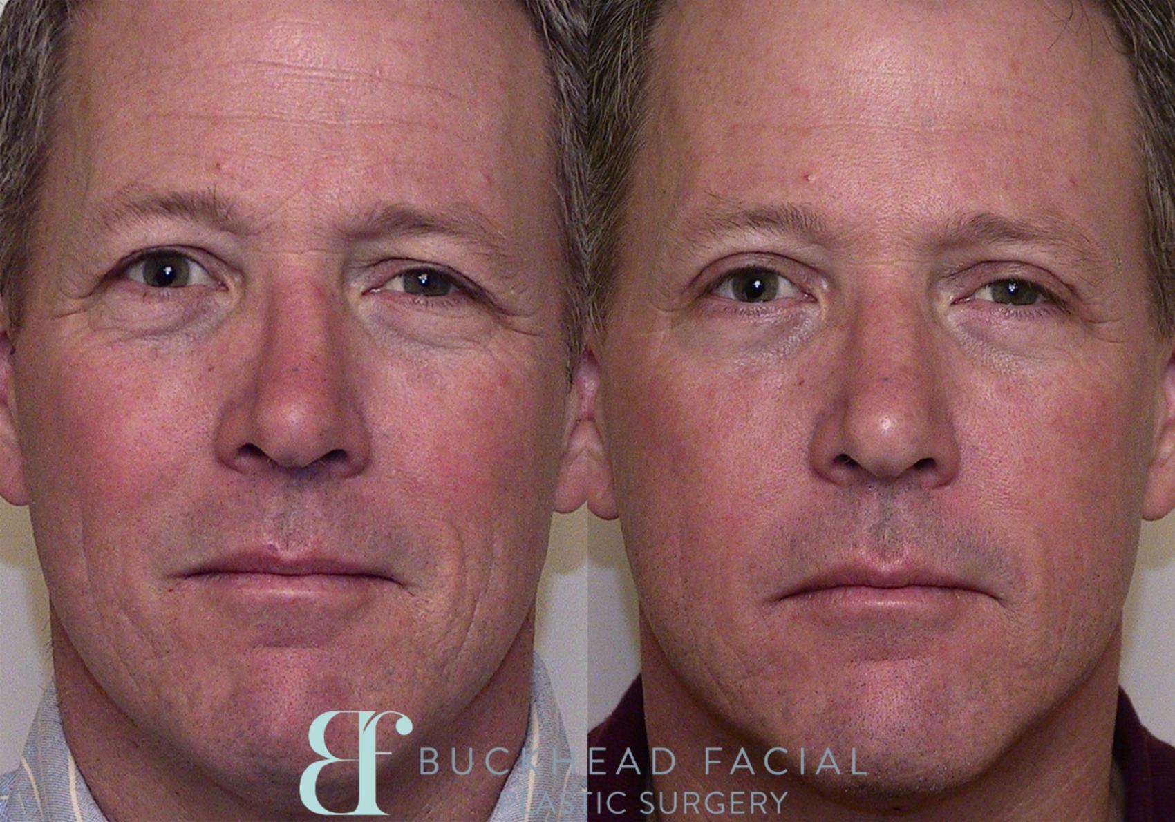 Eyelid Surgery Blepharoplasty Before And After Pictures Case 5