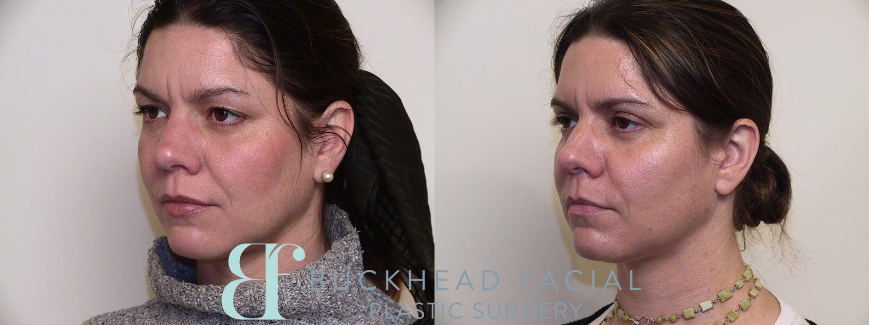 Eyelid Surgery (Blepharoplasty) Before and After Pictures Case 71 ...