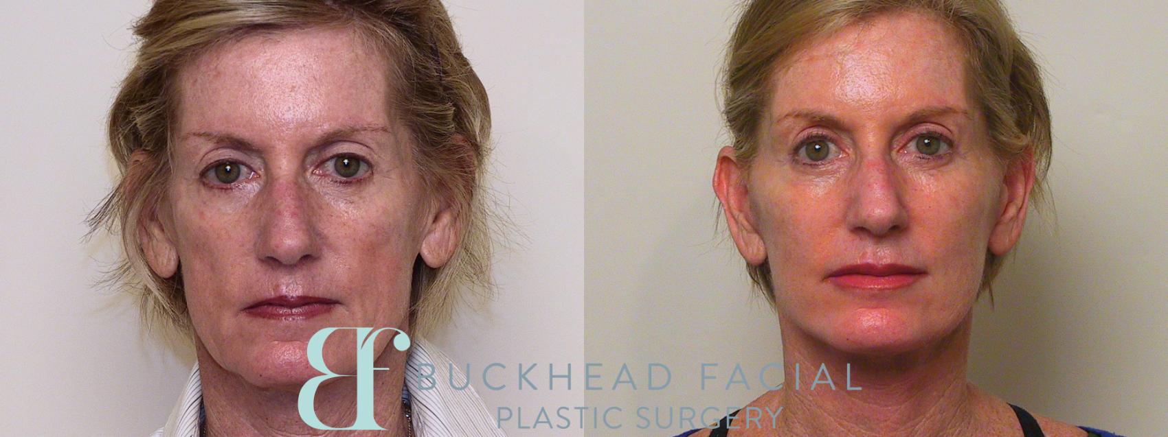 Facelift Before and After Pictures Case 27 | Atlanta, Georgia ...