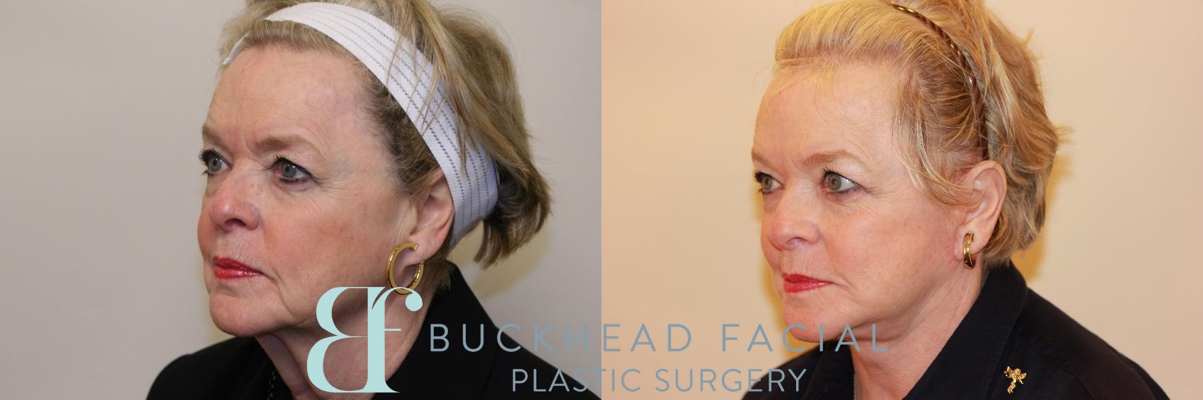 Facelift Before and After Pictures Case 69 | Atlanta, Georgia ...