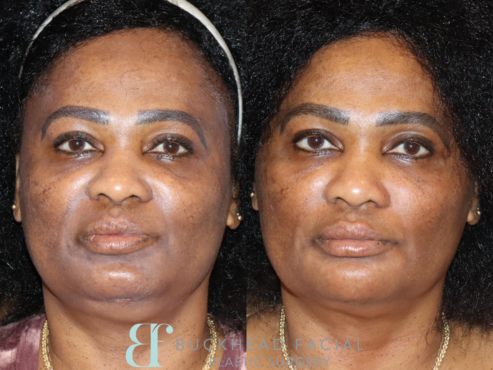 Facial Rejuvenation Before And After Pictures Case 174 Atlanta