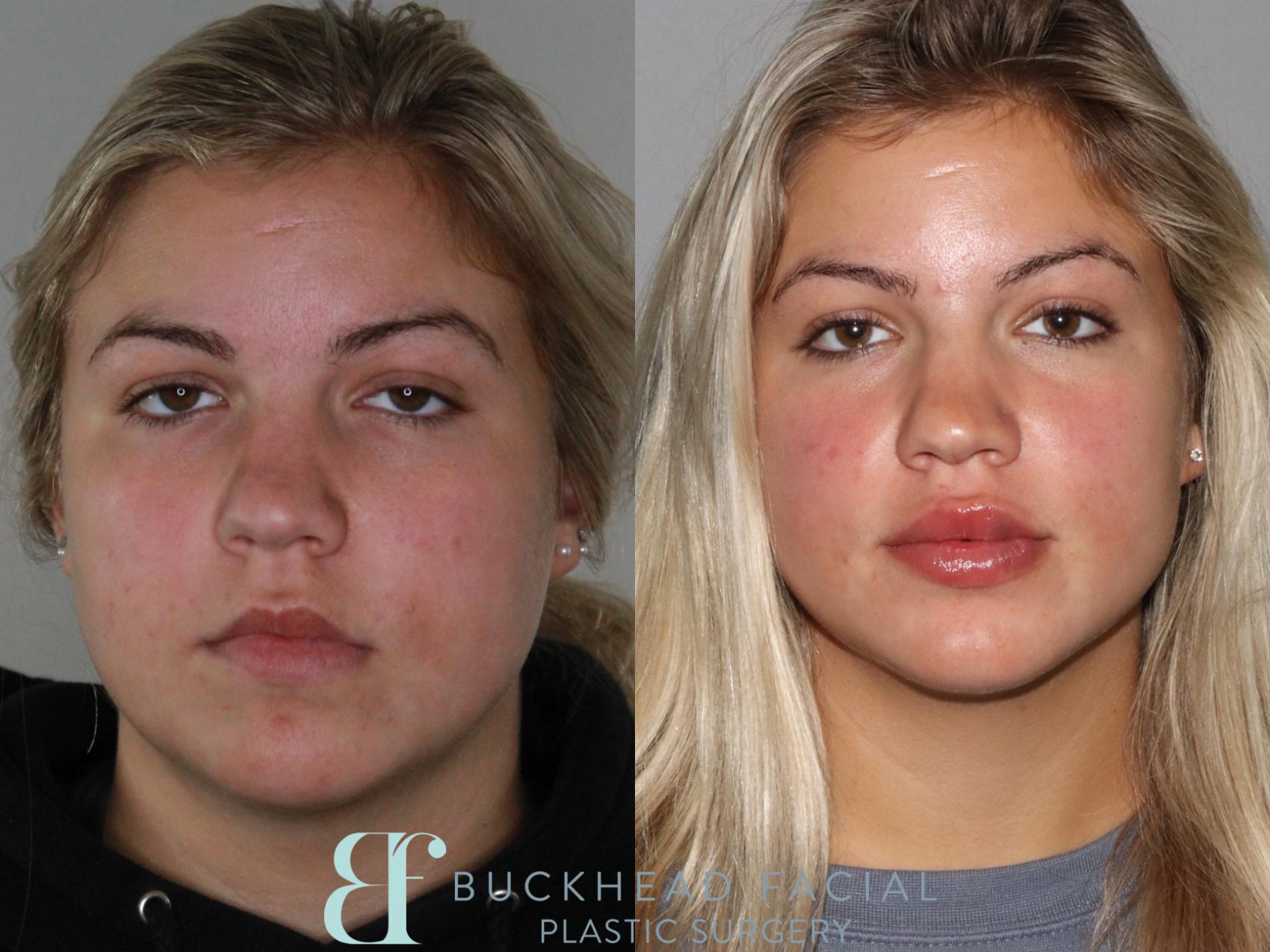 JUVÉDERM Before and After Pictures Case 175 | Atlanta, Georgia ...