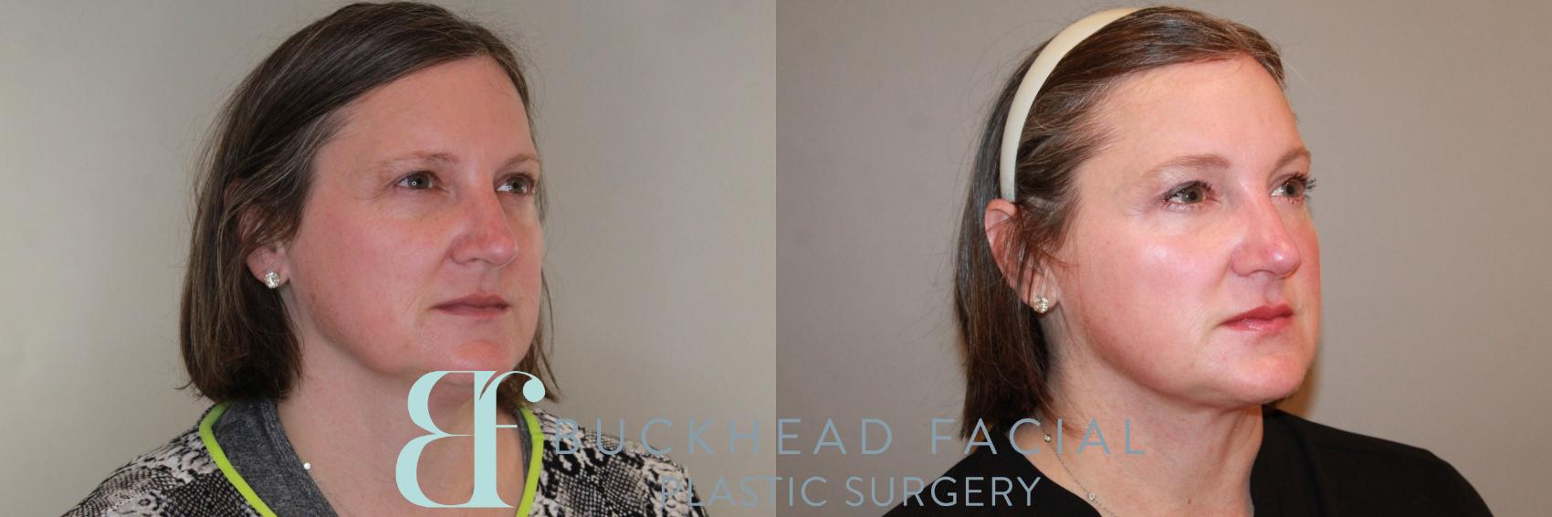 Neck Lift (Submentoplasty) Before and After Pictures Case 163 | Atlanta ...