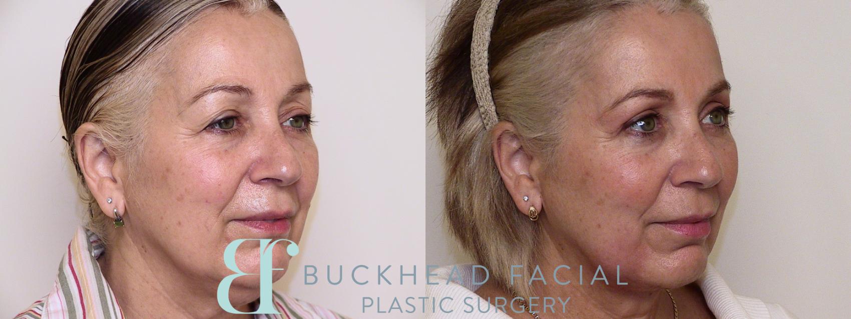 Neck Lift (Submentoplasty) Before and After Pictures Case 43 | Atlanta ...