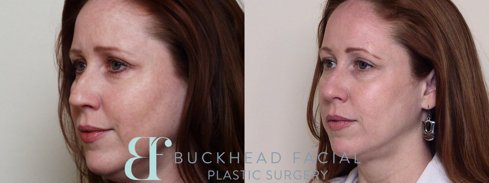 Wow results with minimal downtime