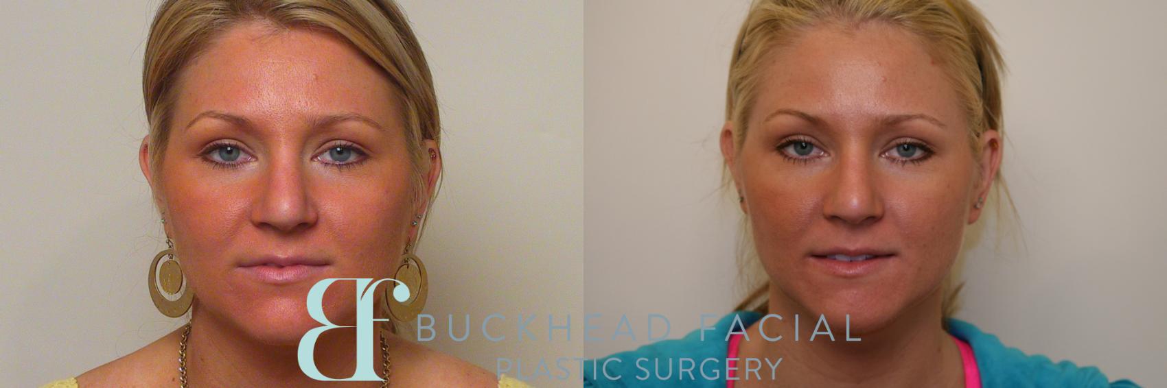 Neck Lift (Submentoplasty) Before and After Pictures Case 50 | Atlanta ...