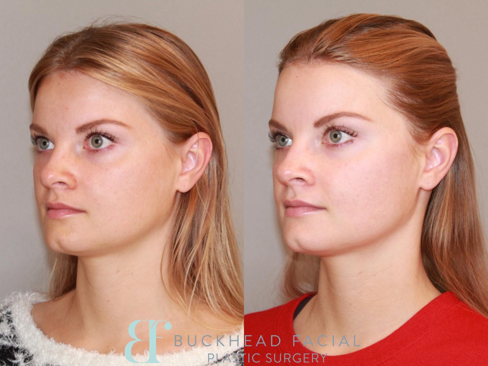 Nova PDO threads Before and After Pictures Case 157 | Atlanta, Georgia ...