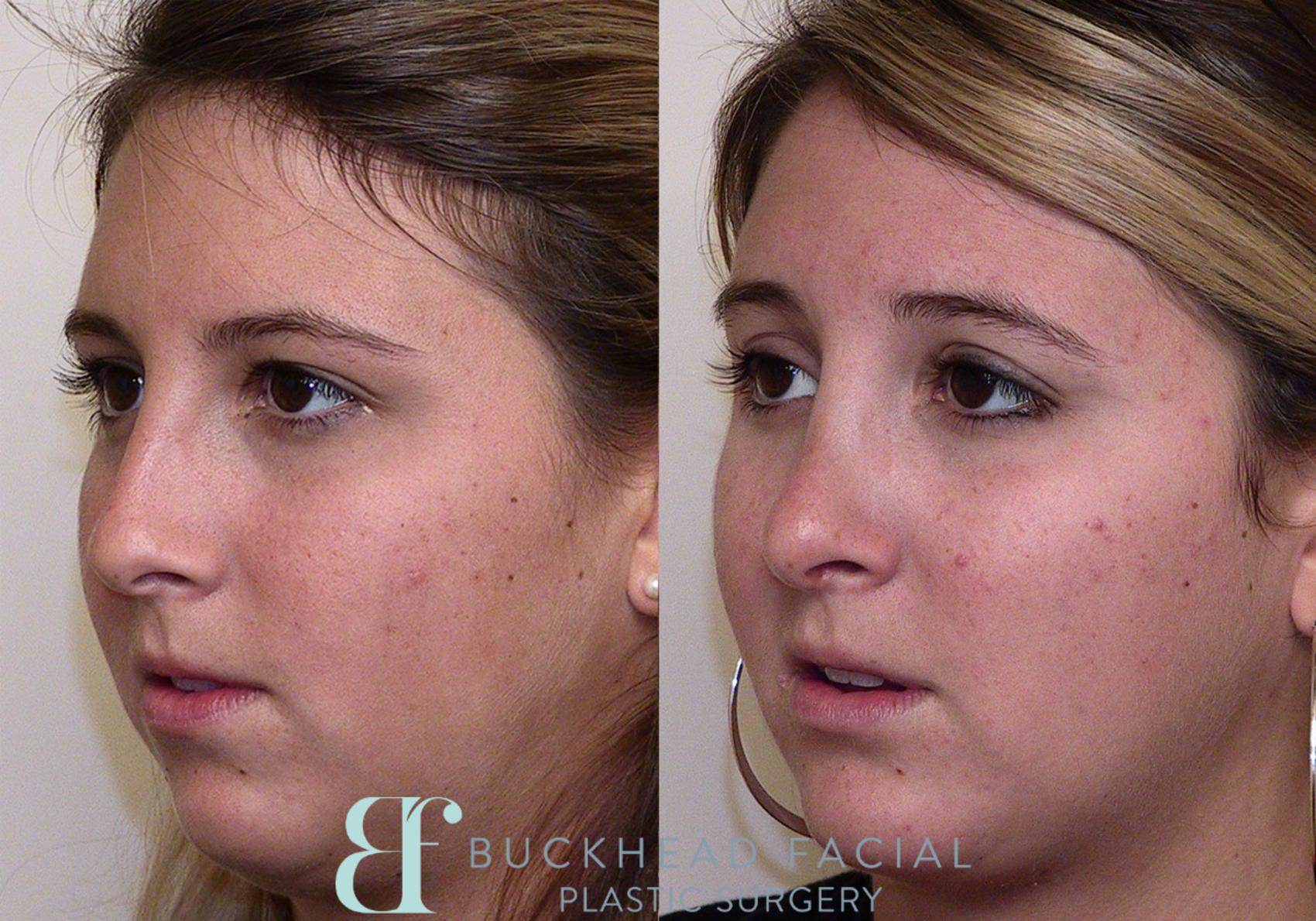 Rhinoplasty with chin implant