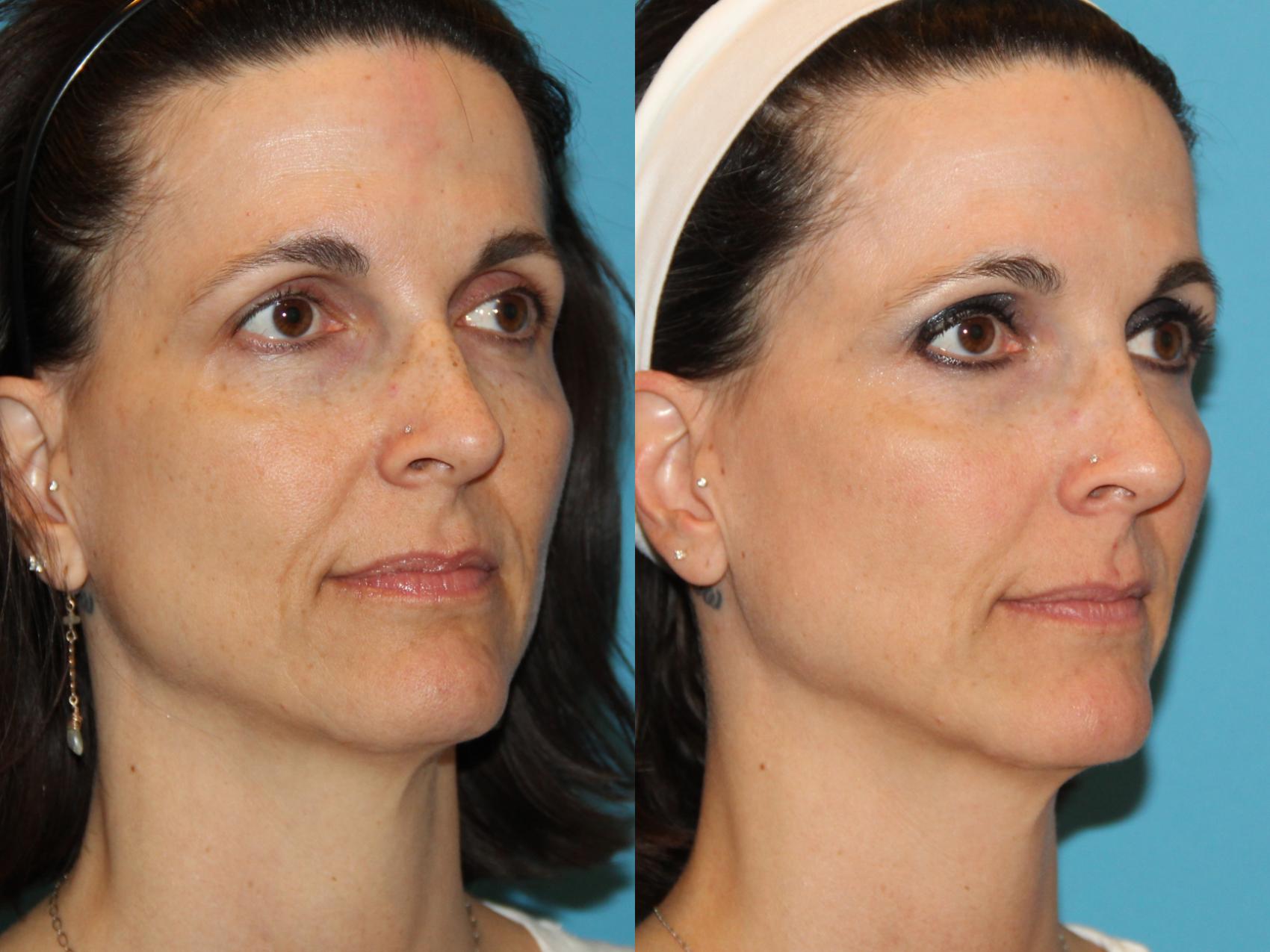 Sculptra® Before And After Pictures Case 98 Atlanta Georgia