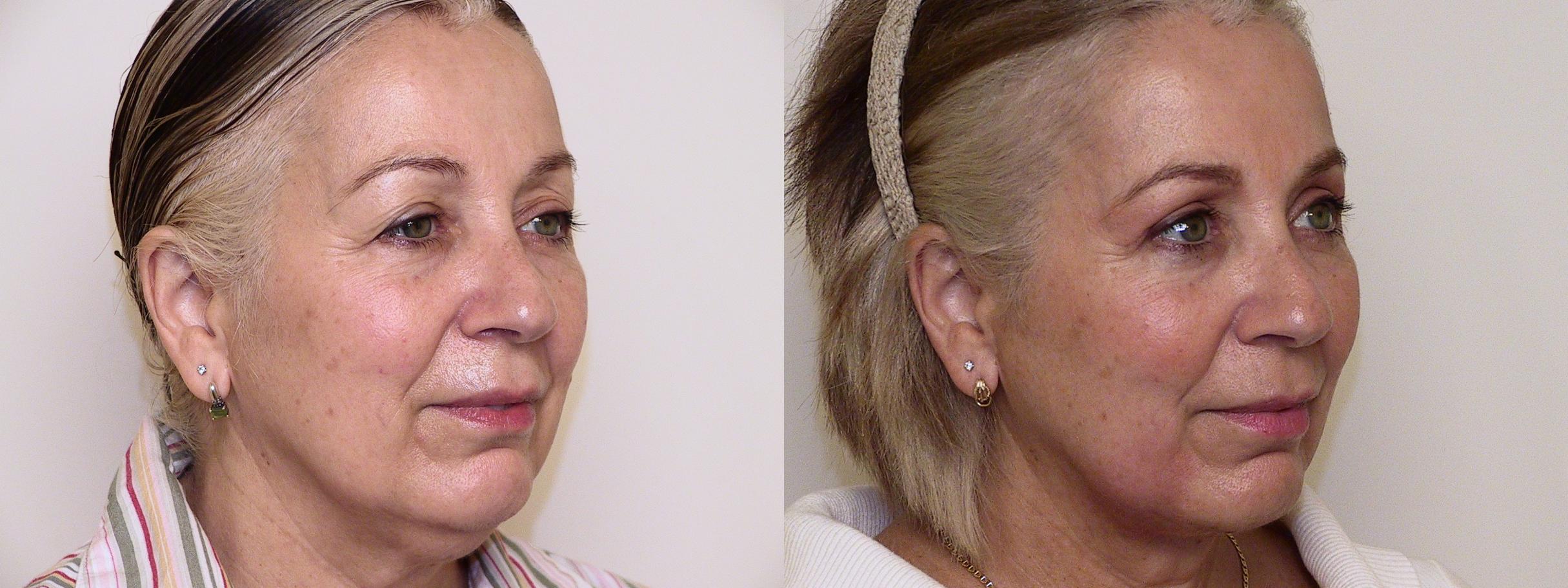 Neck Lift (Submentoplasty) Before and After Pictures Case 43 | Atlanta ...